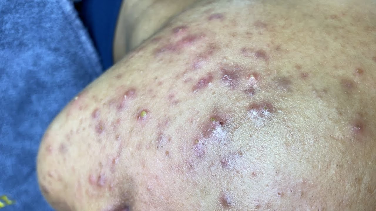 Dr. Sandra Lee Blackhead Pimple Popper Insurance – Dr Sandra Lee